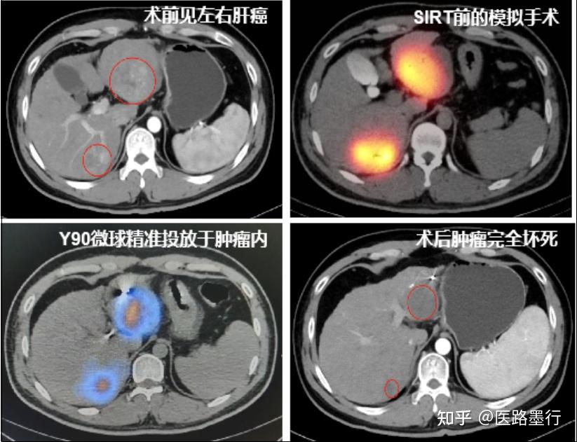 "狙击"肝癌，不用开刀？介入治疗了解一下！ - 知乎