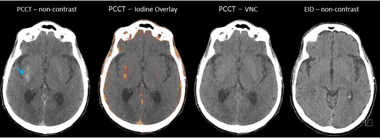 CT技术革命？一文读懂光子计数CT（PCCT）的前沿进展与临床潜力 - 知乎