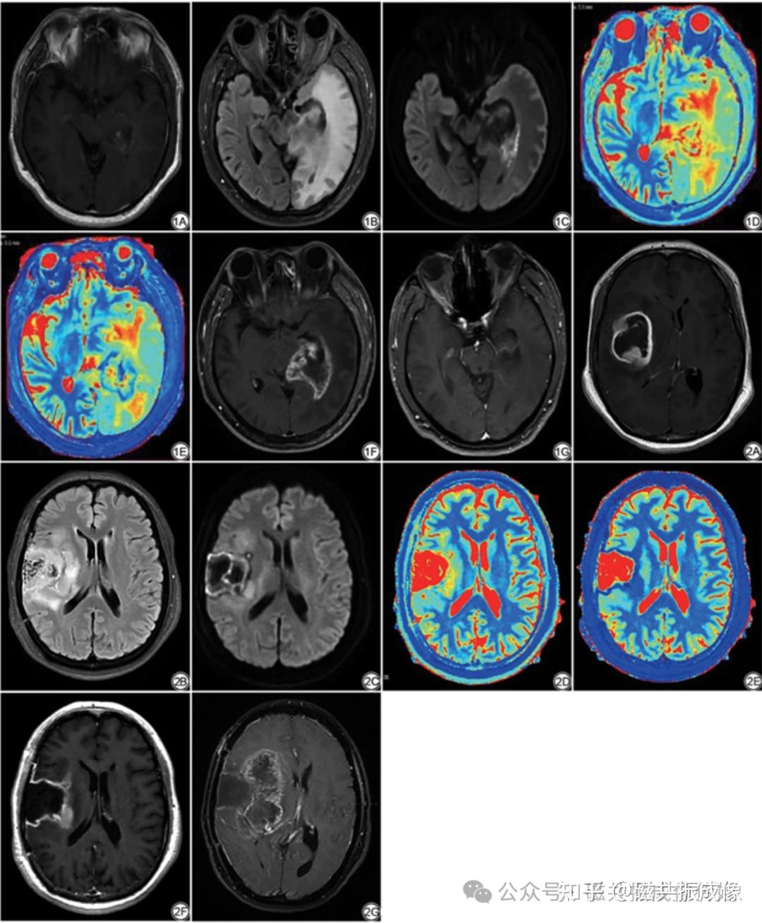 合成MRI联合MUSE-DWI鉴别胶质瘤复发和治疗相关改变的应用研究 - 知乎