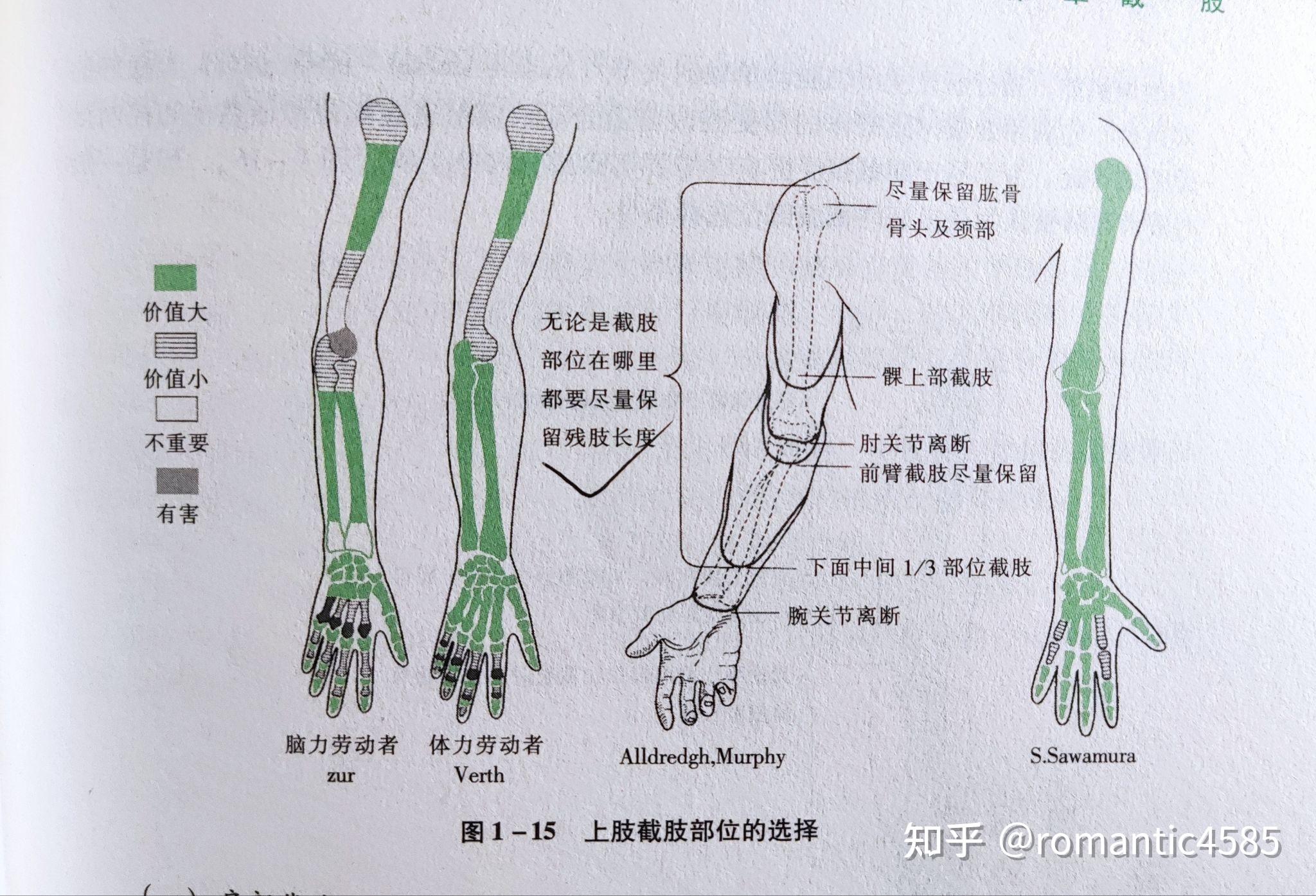 常见的截肢平面图有哪些？ 知乎