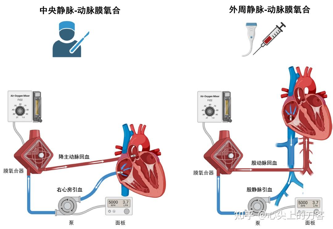 VA-ECMO左室减压: 适应症, 时机与方法 - 知乎