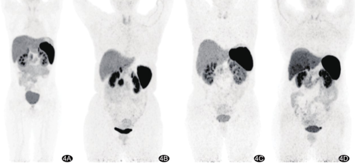 Ga-DOTA-TOC/TMVP1/TRP/iNGR/TOC/LLP2A 镓-大环配体-TOC肽/TMVP1肽/TRP肽/iNGR肽/奥曲肽/拟肽配体 - 知乎