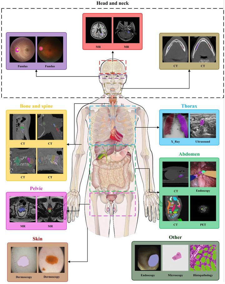 Sa Med2d 20m 医学图像分割数据集开源了！2000万个掩码分割！ 知乎 