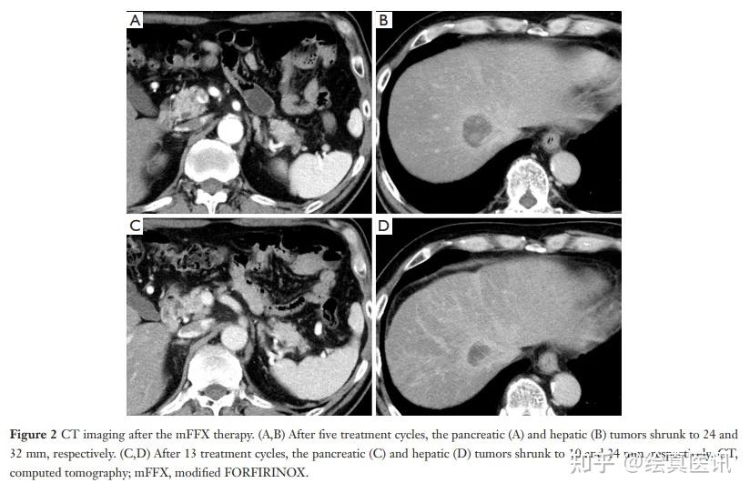 67岁BRCA2胚系突变男性患者，乳腺癌后罹患胰腺腺泡细胞癌，一线mFFX化疗缩瘤获手术机会 - 知乎