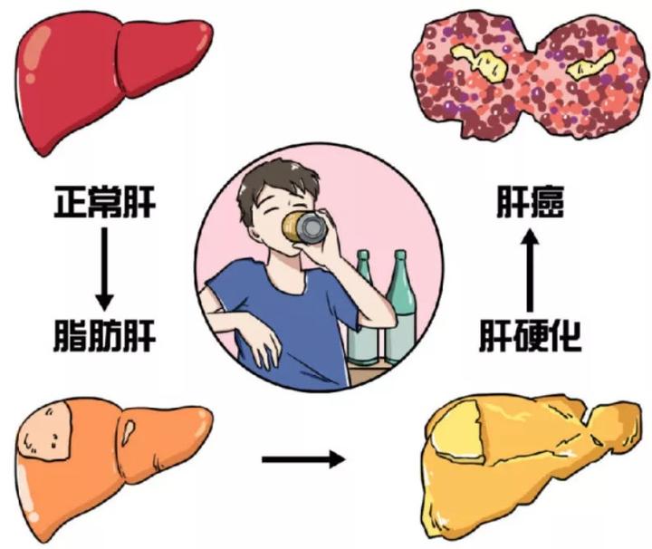 脂肪肝也可能癌变！再不注意，身体出现这些 信号”时就成晚期了 知乎
