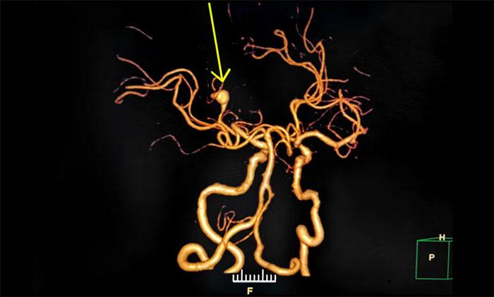 脑血管病做什么检查？专家解读：CTA、MRA、DSA - 知乎