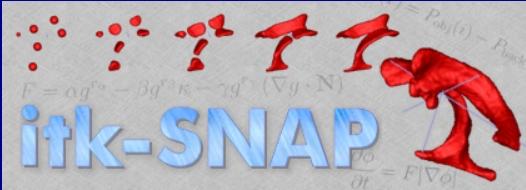 [项目实战]基于UNet的肝脏肿瘤多类分割（一）ITK-SNAP调窗 - 知乎