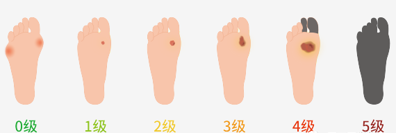 糖尿病足溃疡辅助治疗(二) - 知乎