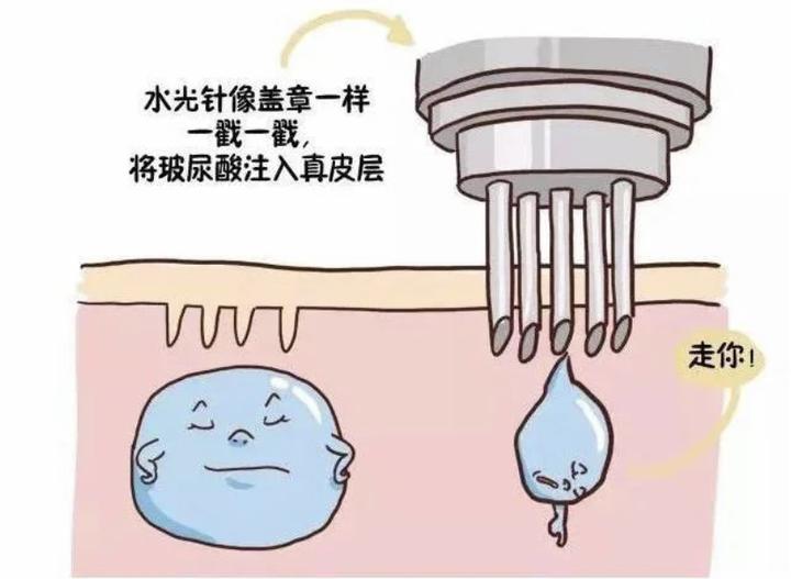 水光针有副作用吗?不打了会不会皮肤更差? 知乎
