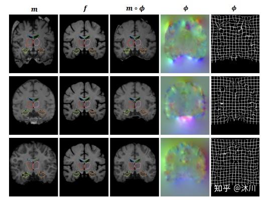 图像配准-VoxelMorph - 知乎