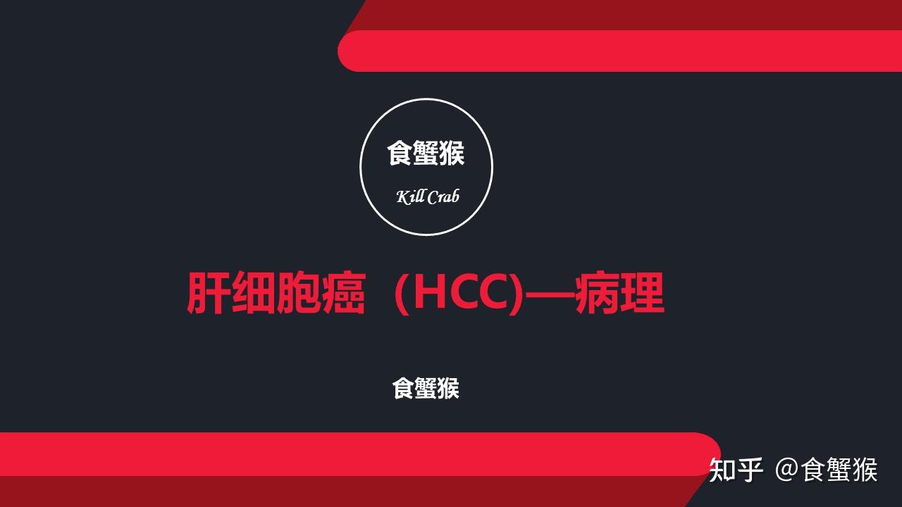 肝细胞癌（HCC)—病理 - 知乎