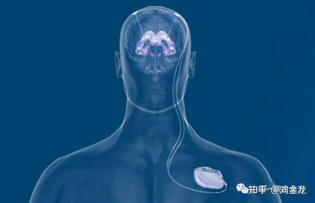 dbs手术后能维持几年？ - 知乎