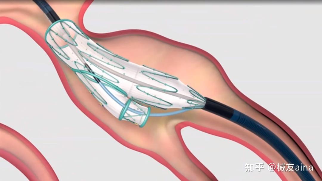 美国上市！库克ZBIS支架：髂动脉瘤患者治疗大突破，中国何时用上？ZBIS支架既“堵瘤”又“保血流”，髂动脉瘤治疗新突破！ - 知乎