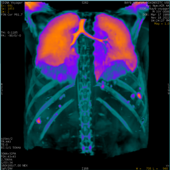 Chest MRI - 知乎