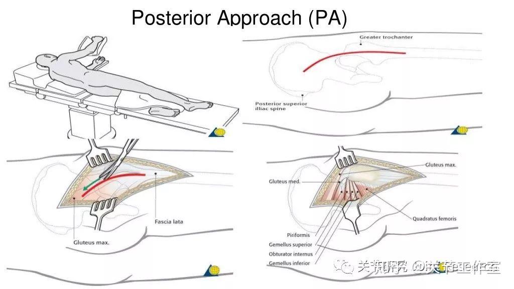 最照顾女性美观的全髋切口——DAA入路 - 知乎