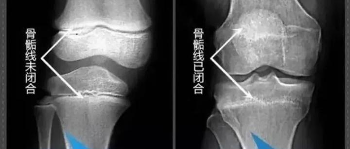 什么是骨骺线？怎么判断骨骺线开始闭合？ 知乎