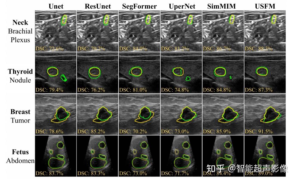 USFM：适用于各种任务和器官的通用超声基础模型，实现标签高效图像分析 - 知乎