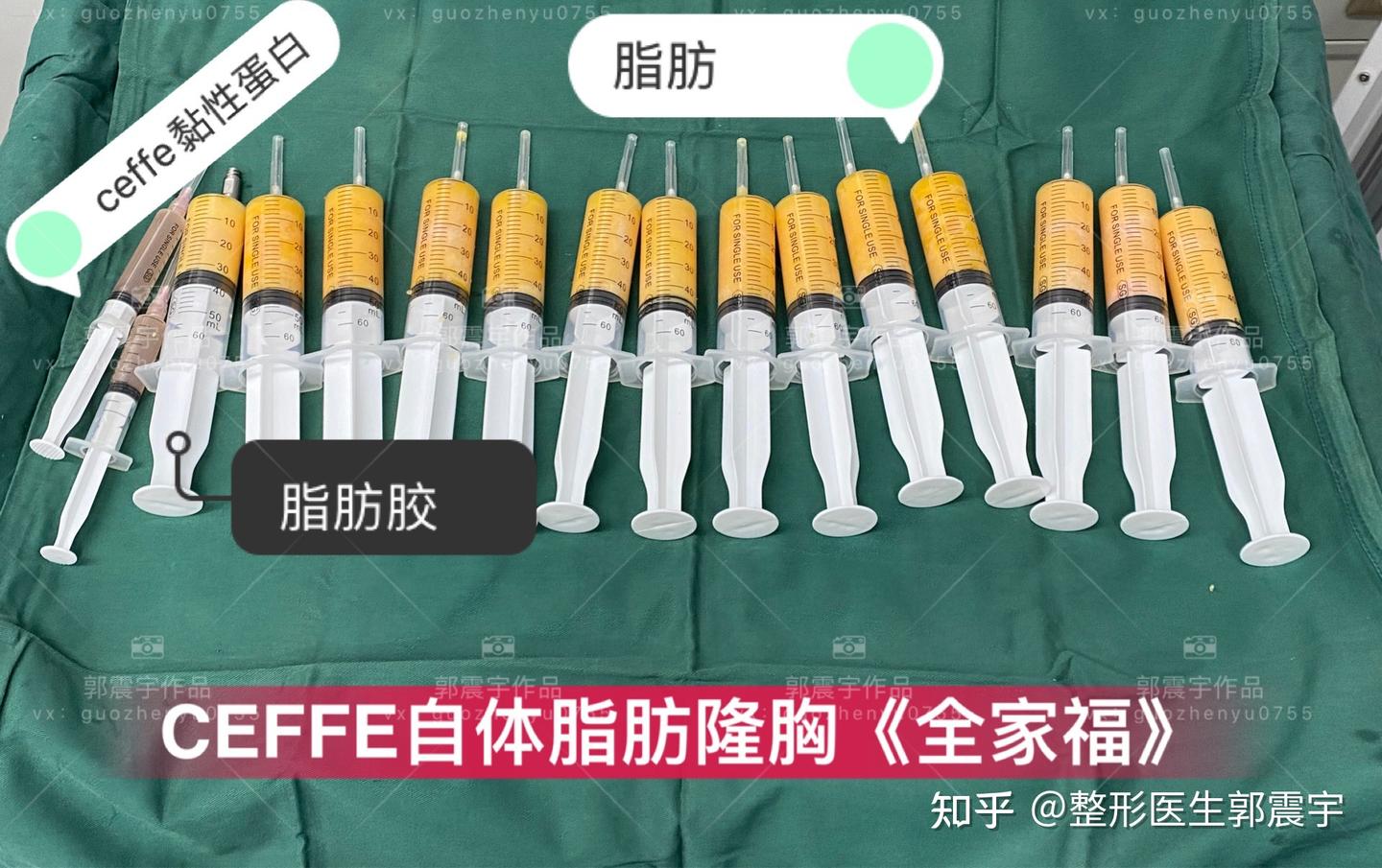 郭震宇CEFFE®自体脂肪隆胸好吗？原理是什么？效果怎么样？ - 知乎