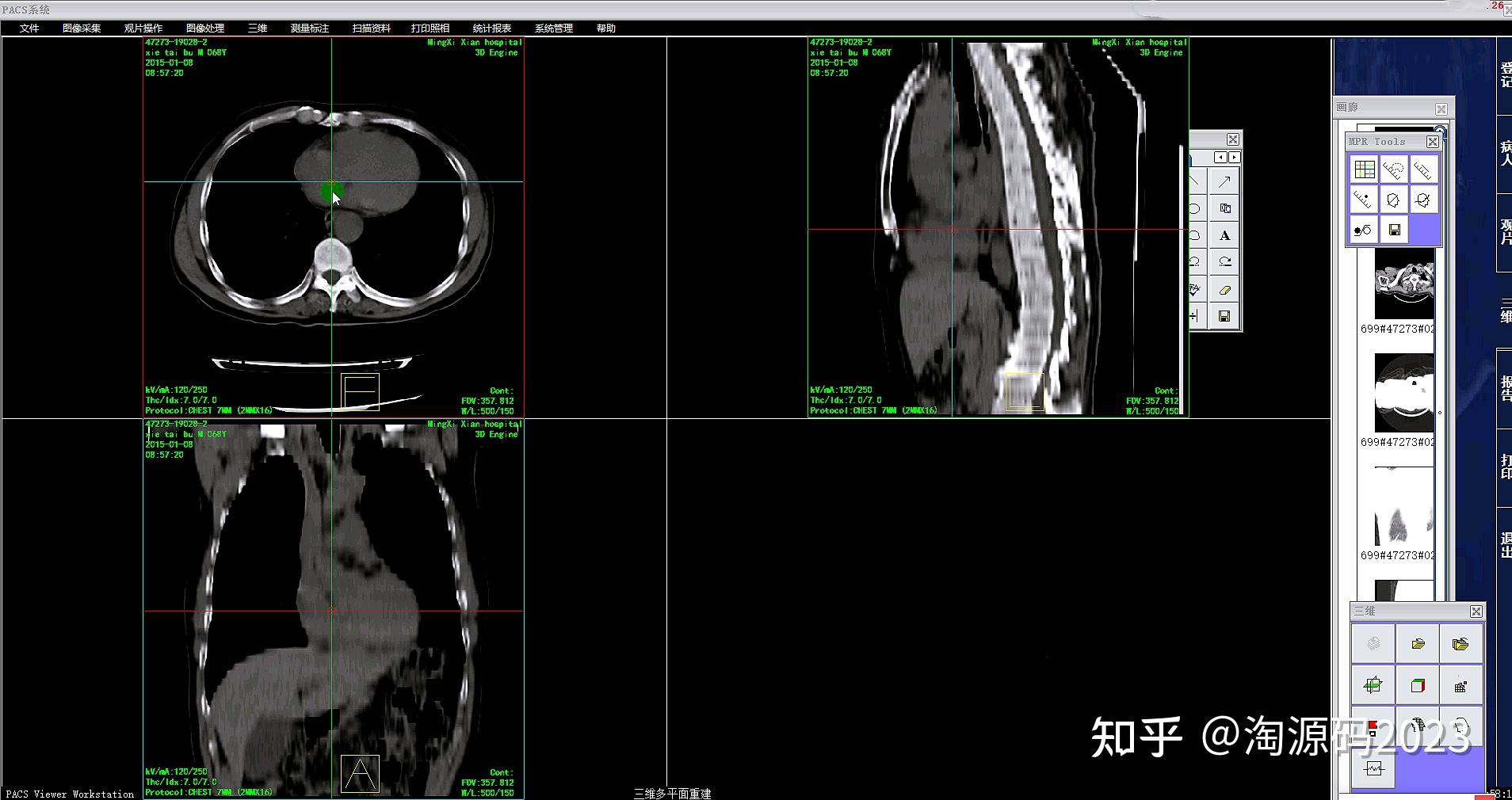 医学影像系统源码（MRI、CT三维重建） - 知乎