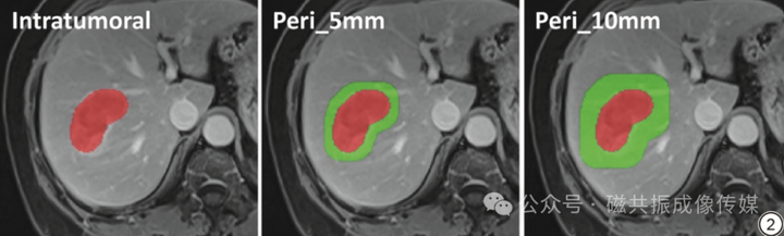 基于CEMRI瘤内瘤周影像组学预测肝细胞癌分化程度的研究 - 知乎