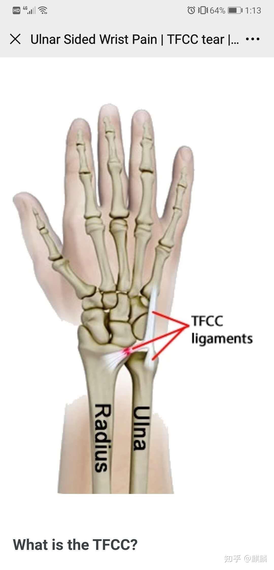 手腕tfcc韧带仍然是我国医学的软肋 - 知乎