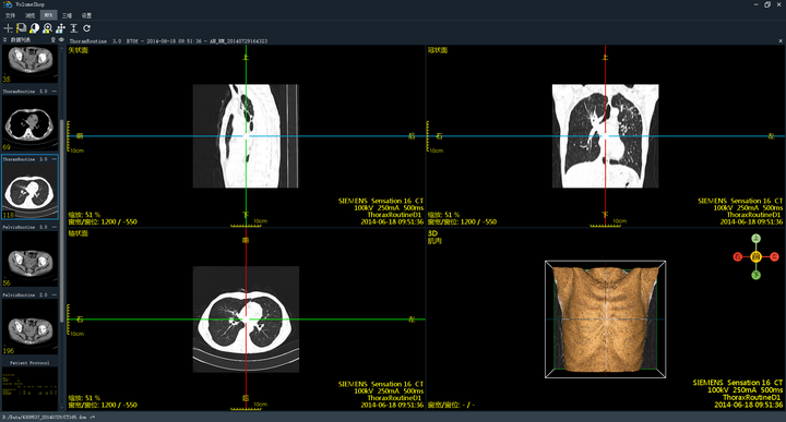 医学影像MPR、MIP、MinIP和AIP介绍 - 知乎