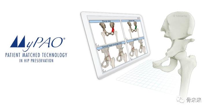 首例手术！“CT+3D”骨科规划平台 - 知乎