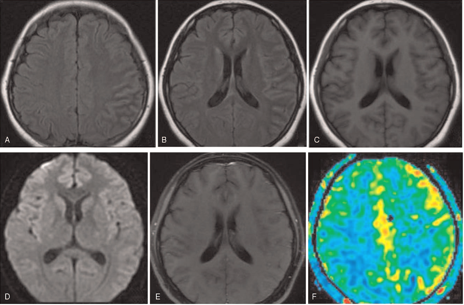 难倒大部分神内医生的MOG抗体病，8大临床表型一文掌握 - 知乎