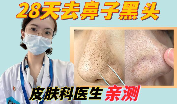 鼻子黑头大的像芝麻粒,去鼻子黑头、收缩毛孔最好的方法是什么?【皮肤科医生】手把手教你28天去鼻子黑头,从此摆脱 草莓鼻”!! 知乎
