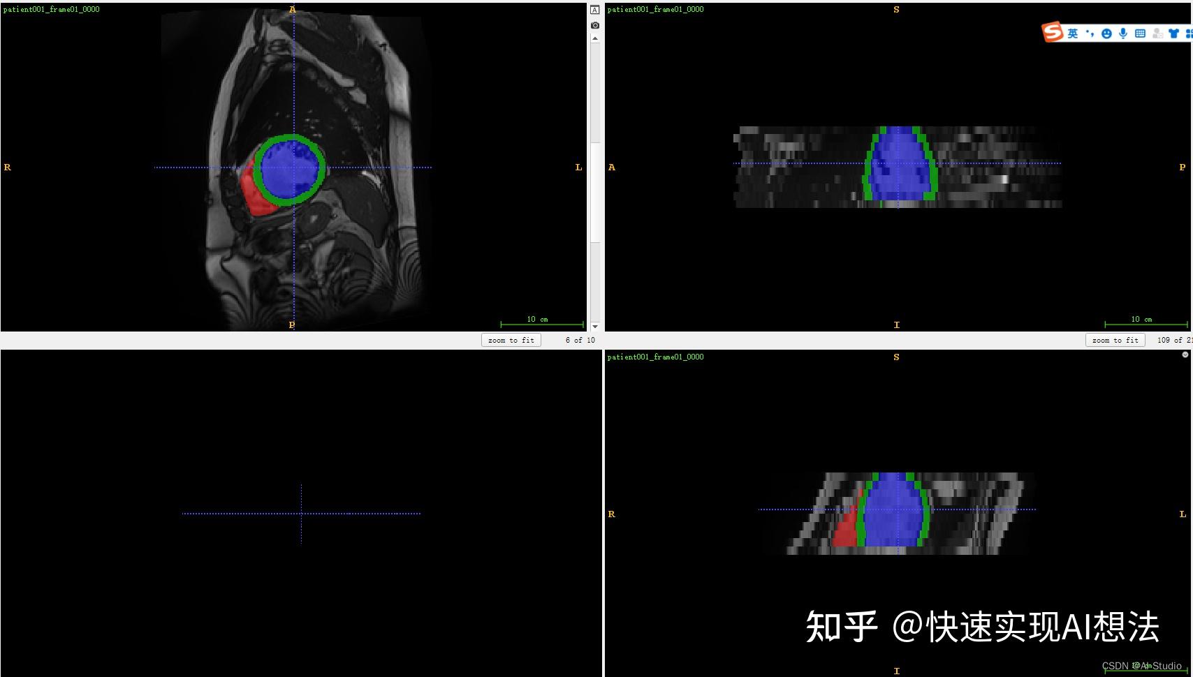 论文复现：nnformer-3d医学图像分割 - 知乎