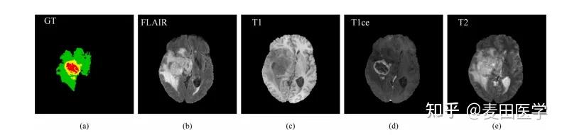 基于多模态MRI中深层语义和边缘信息融合的脑肿瘤分割 | 文献速递-深度学习肿瘤自动分割 - 知乎
