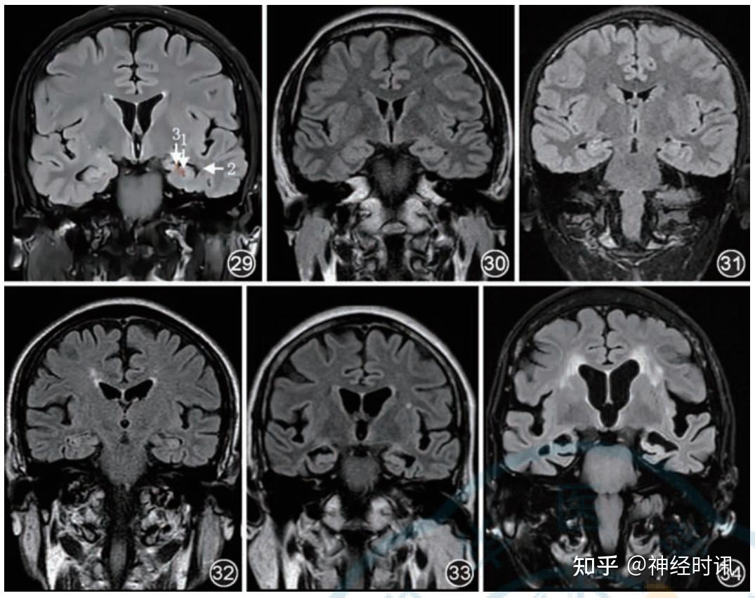 新指南发布！脑小血管病的MRI诊断，一文总结！ - 知乎