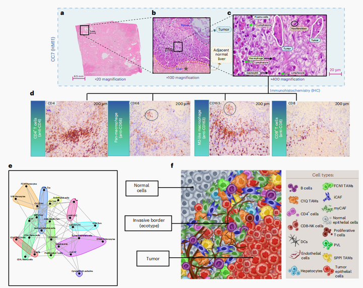 Nat Gen | 空间解析转录组学研究胰腺癌中的侵袭性生态型与免疫细胞富集 - 知乎