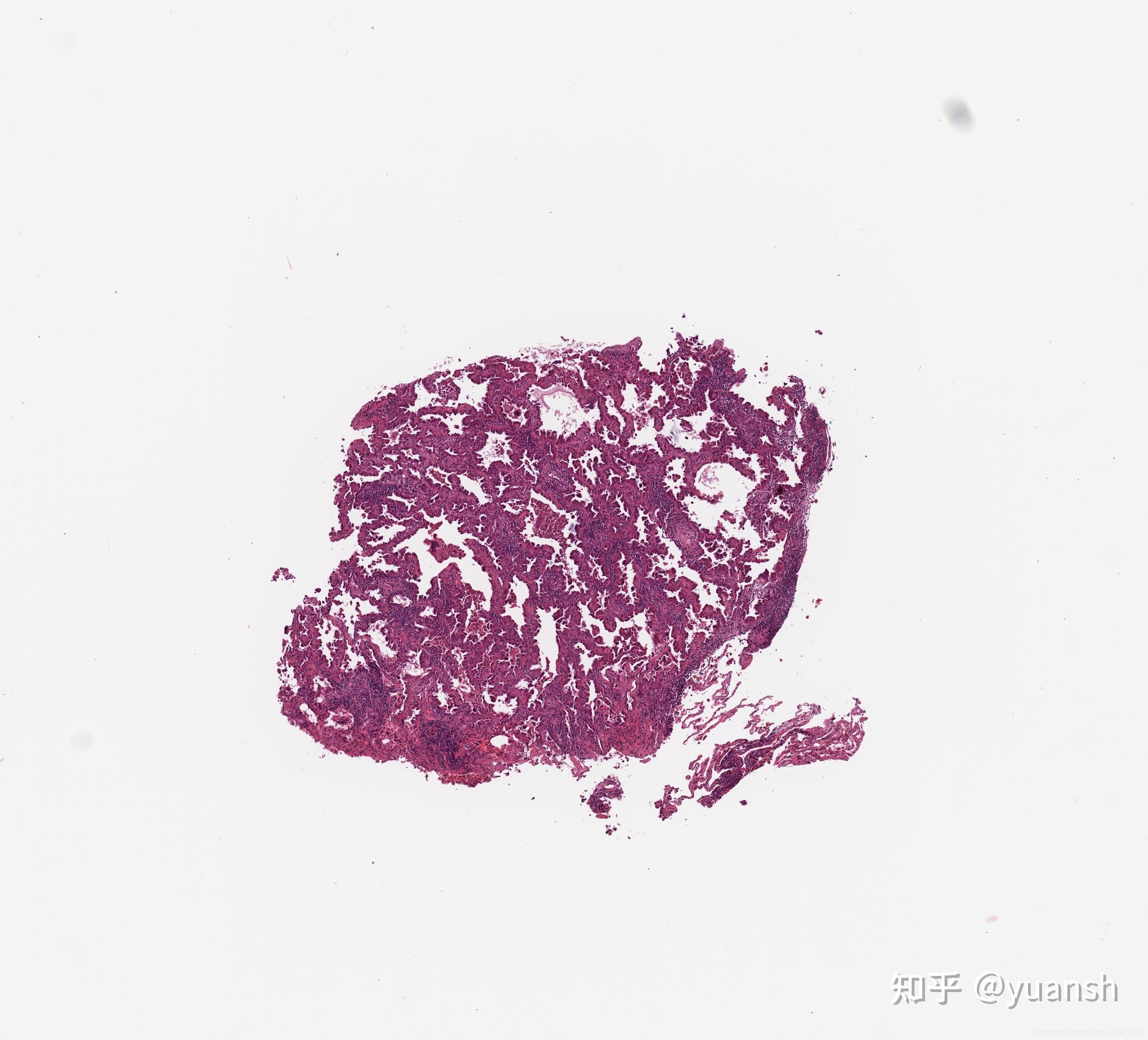 CLAM: A Deep-Learning-based Pipeline for Data Efficient and Weakly Supervised Whole-Slide-level ...