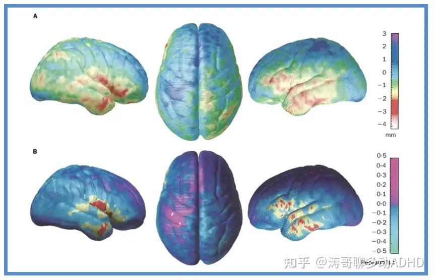 ADHDer时间盲症的本质是整个社会运行的时间节奏，默认不为我们设计！ - 知乎