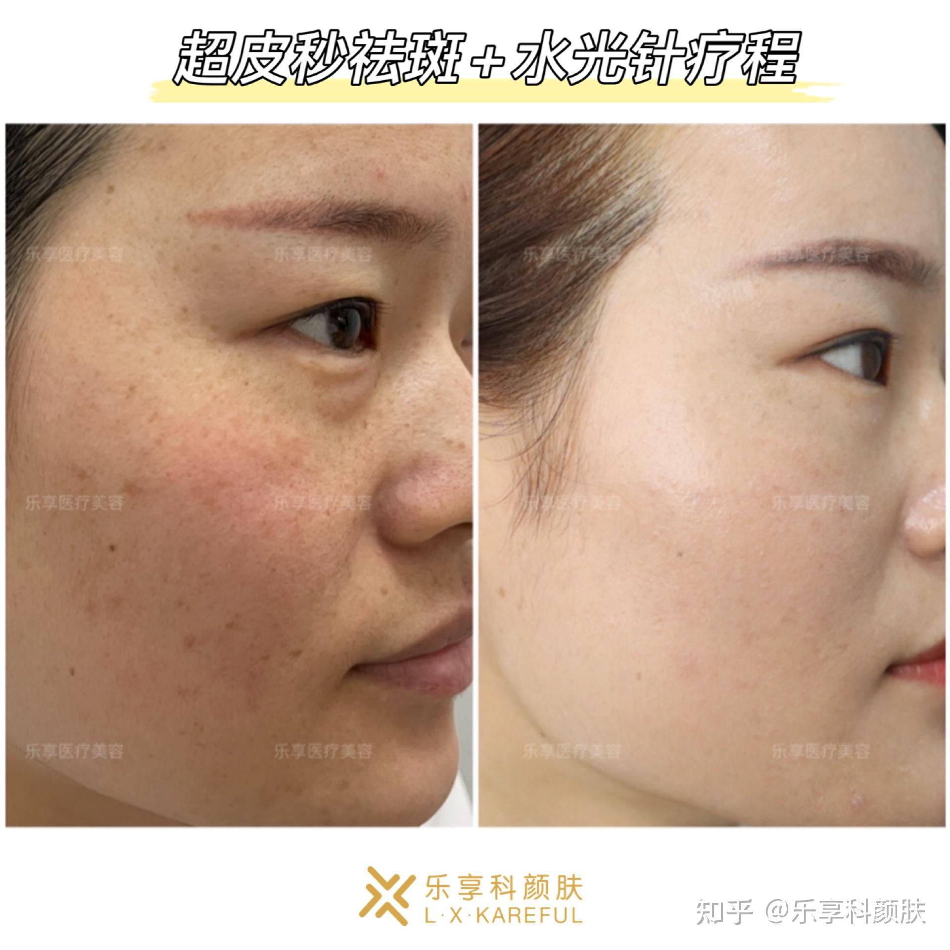 做完皮秒该怎么护理？ 知乎