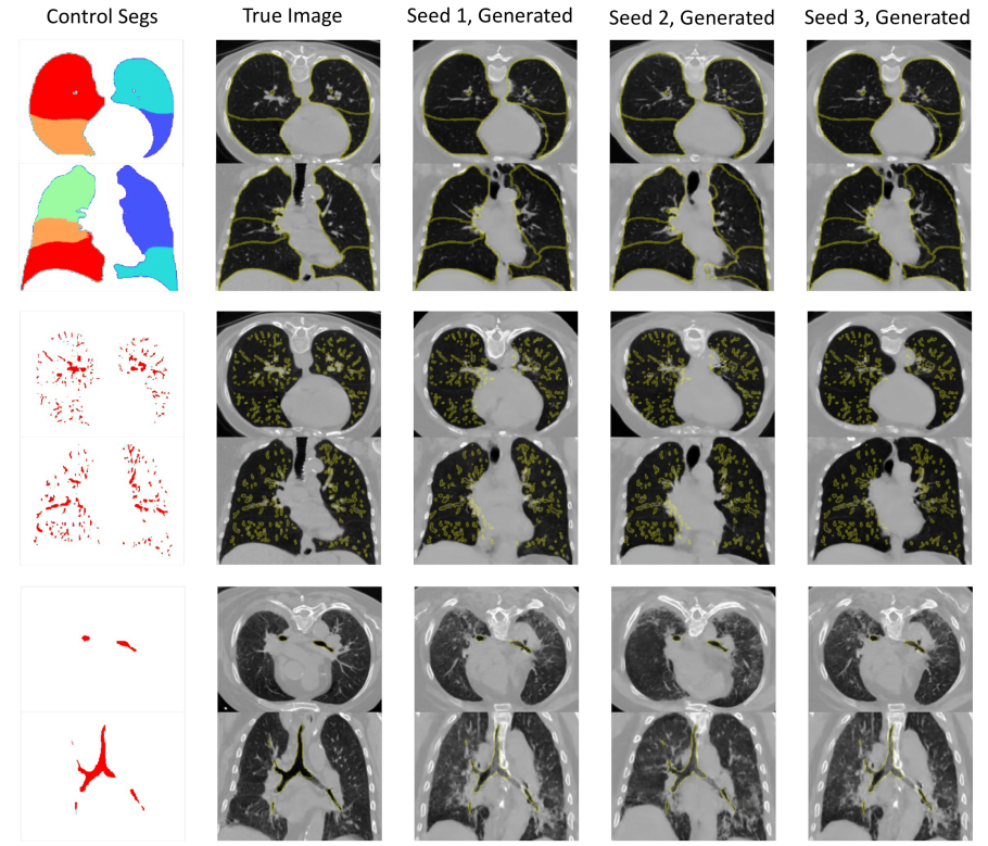 医学生成模型MedSyn：文字引导，AI“画”出高保真CT图像 - 知乎