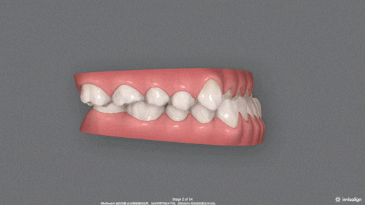 入选Invisalign Global Gallery |成人骨性地包天，非手术+0拔牙+0骨钉，14个月拥有好看侧颜！ - 知乎