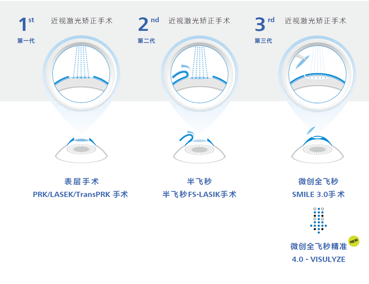 全飞秒也能微创个性化？4.0-VISULYZE系统技术全揭秘 - 知乎