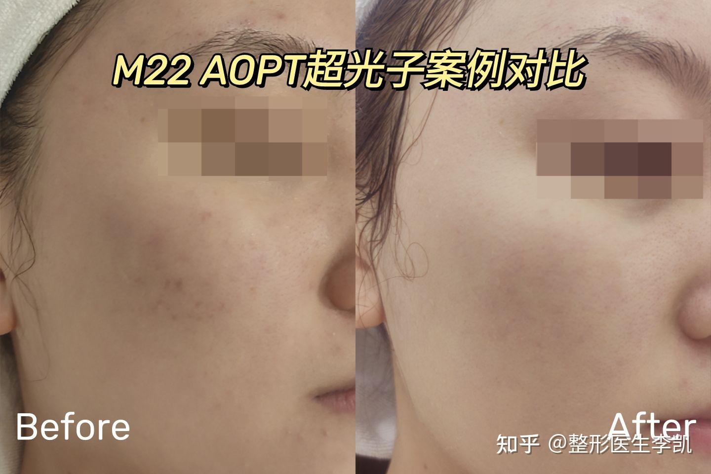 M22 AOPT超光子：到底什么是AOPT超光子？ - 知乎