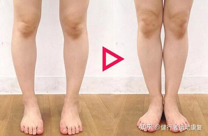 O型腿如何科学矫正？干货文章分享 - 知乎