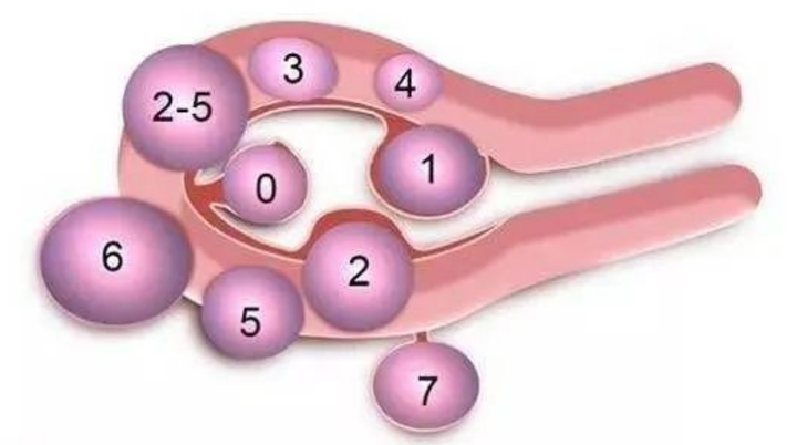 子宫肌瘤的分型 - 知乎