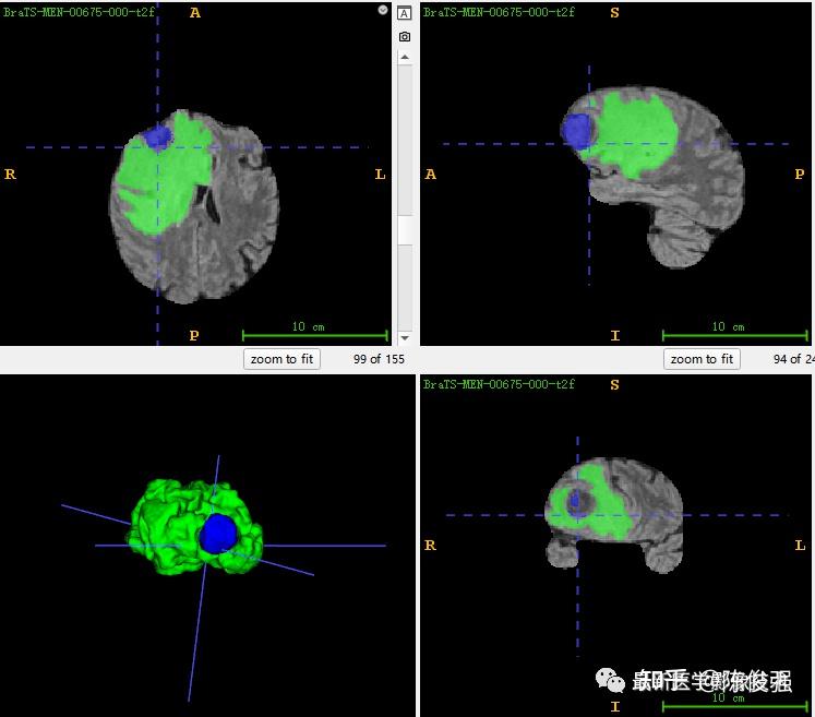 BraTS2023-MEN——BraTS2023颅内脑膜瘤分割挑战赛 - 知乎