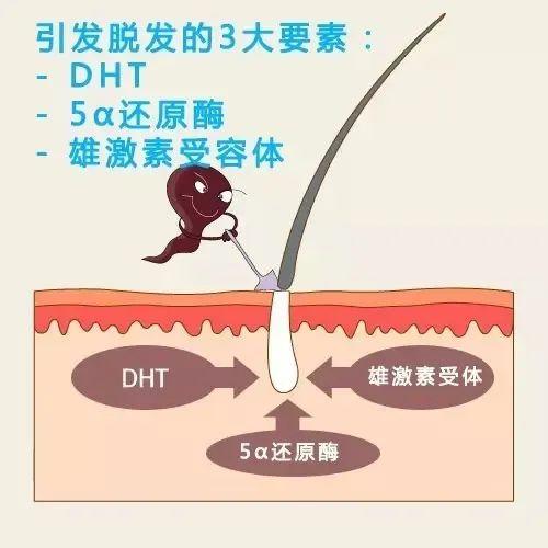 什么是DHT脱发？ - 知乎