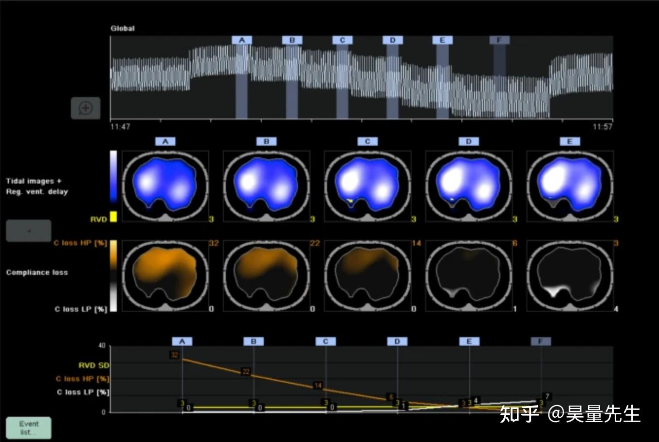 胸阻抗断层成像仪临床前解决方案—Sciospec Lung EIT Kit - 知乎
