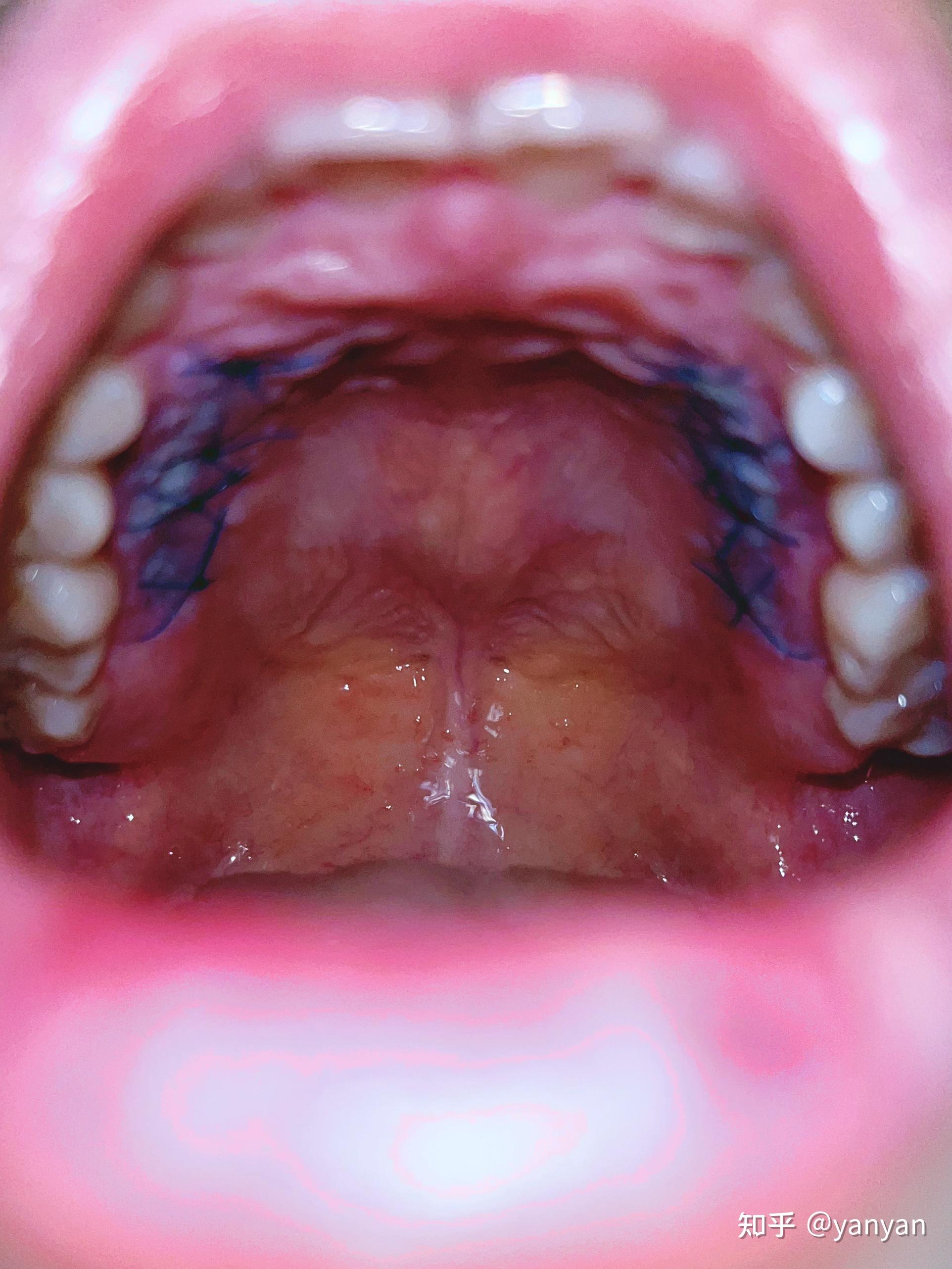 牙周膜龈手术+植骨（PAOO）记录 - 知乎