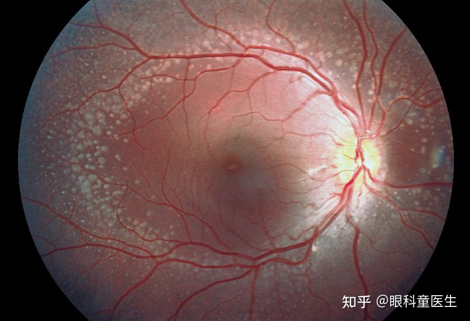 视网膜变性病变——3、白点状视网膜变性 - 知乎