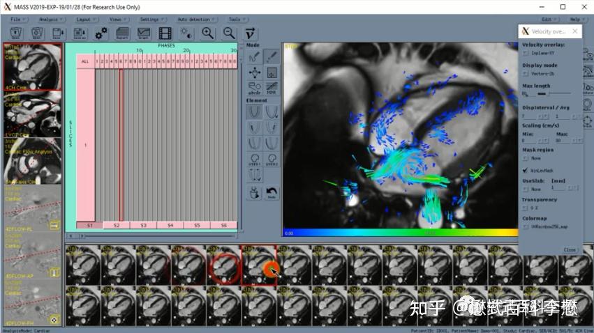 4D-Flow扫描数据采集：序列及参数 - 知乎