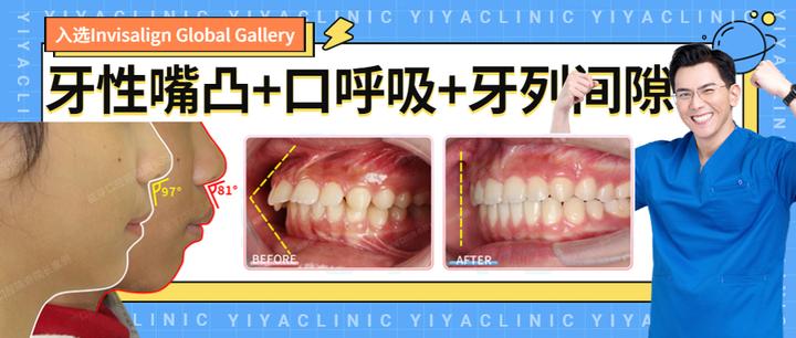 入选Invisalign Global Gallery | 牙性嘴凸+口呼吸+牙列间隙，正畸打造精致侧颜！ - 知乎