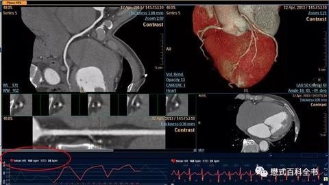 CT基础知识——扫描方式 - 知乎